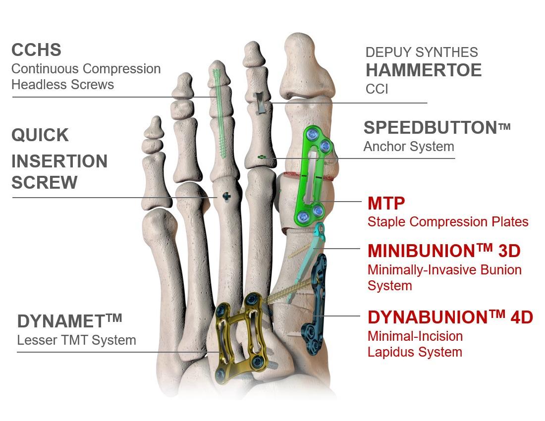 FootInnovate.com :: DePuy Synthes Foot & Ankle FootInnovate.com :: DePuy Synthes Foot & Ankle